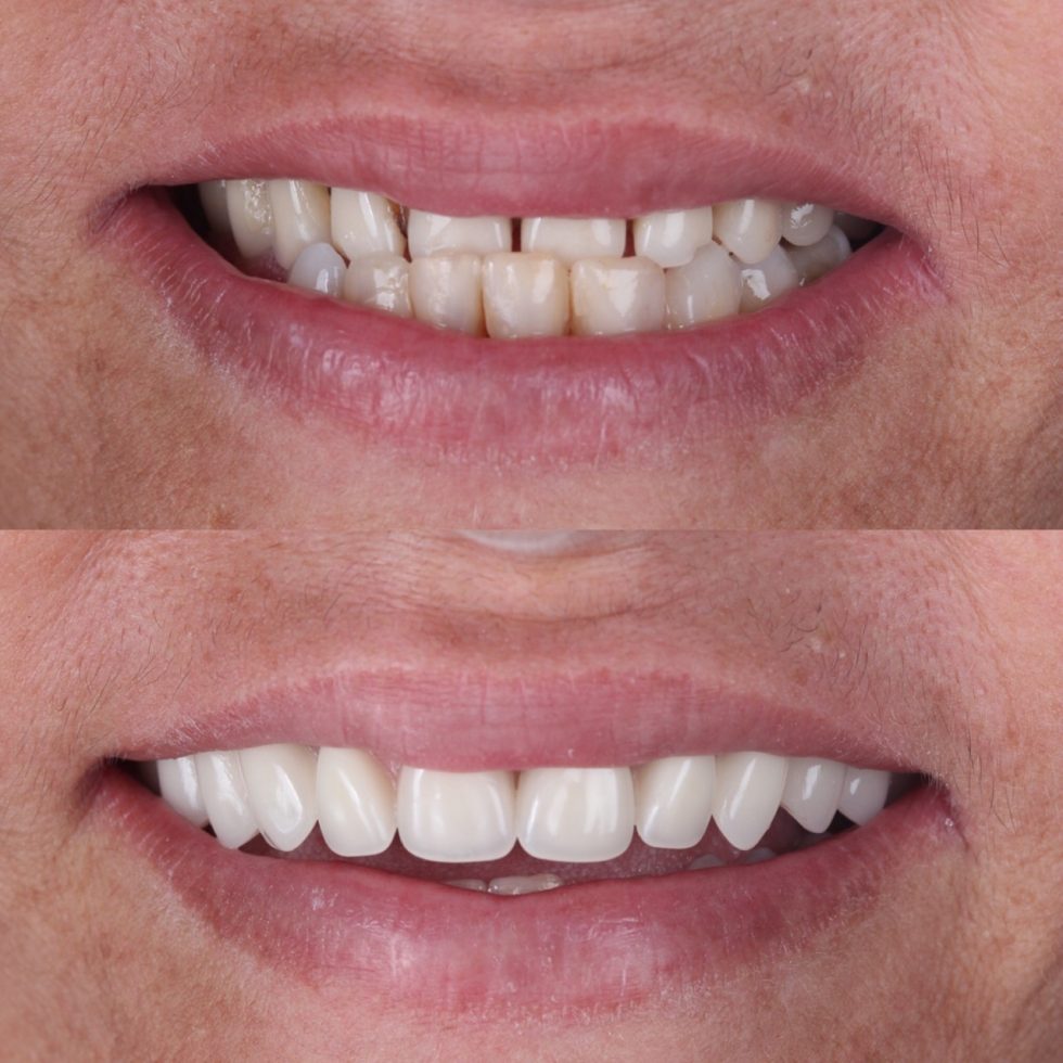 Prótese total superior | Saiba como é realizado esse procedimento