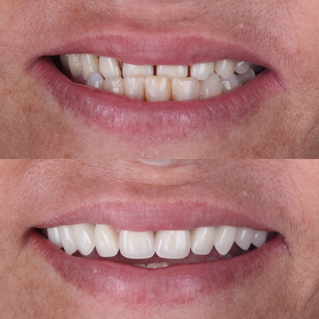 Prótese total superior | Saiba como é realizado esse procedimento